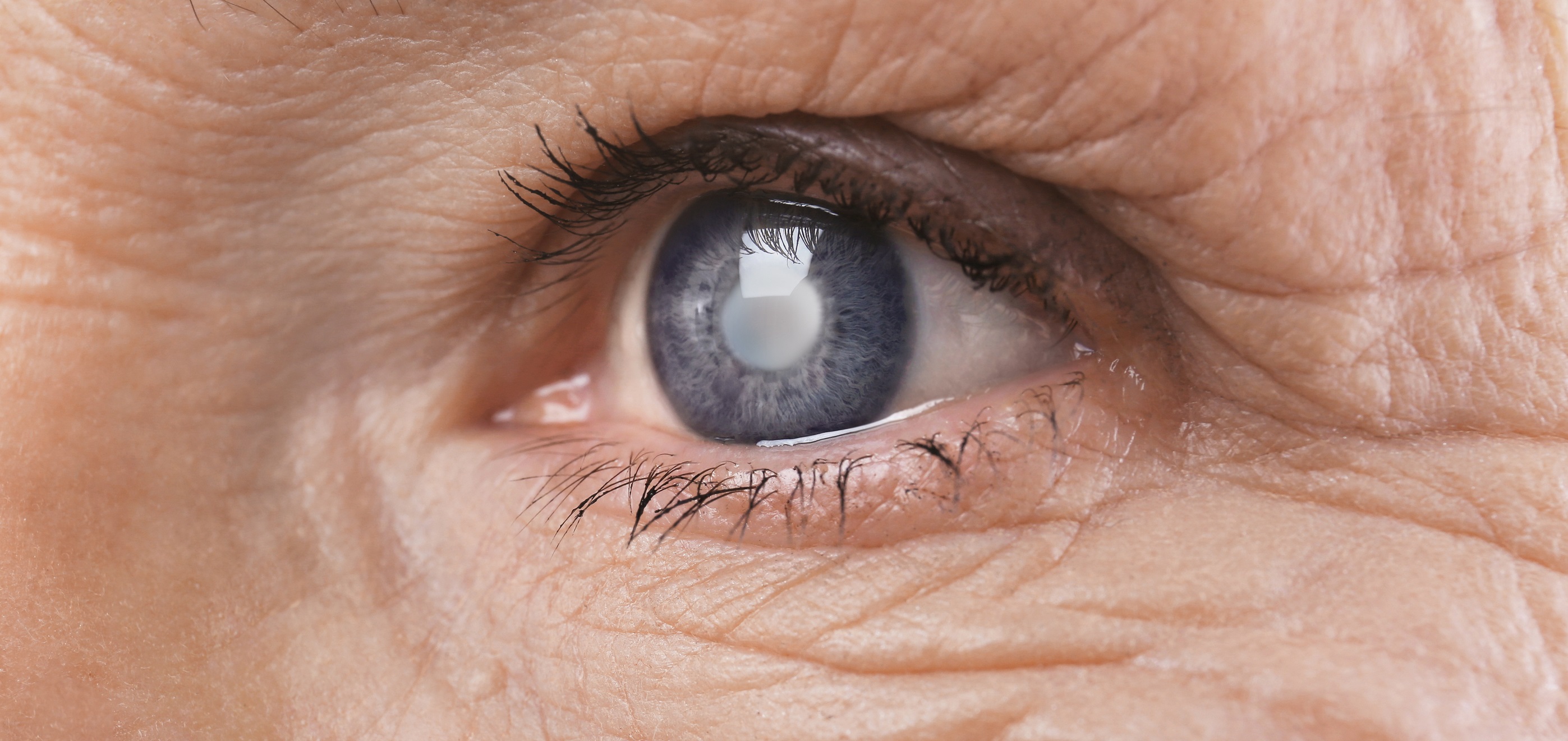 Como Feito O Diagn stico Do Glaucoma 